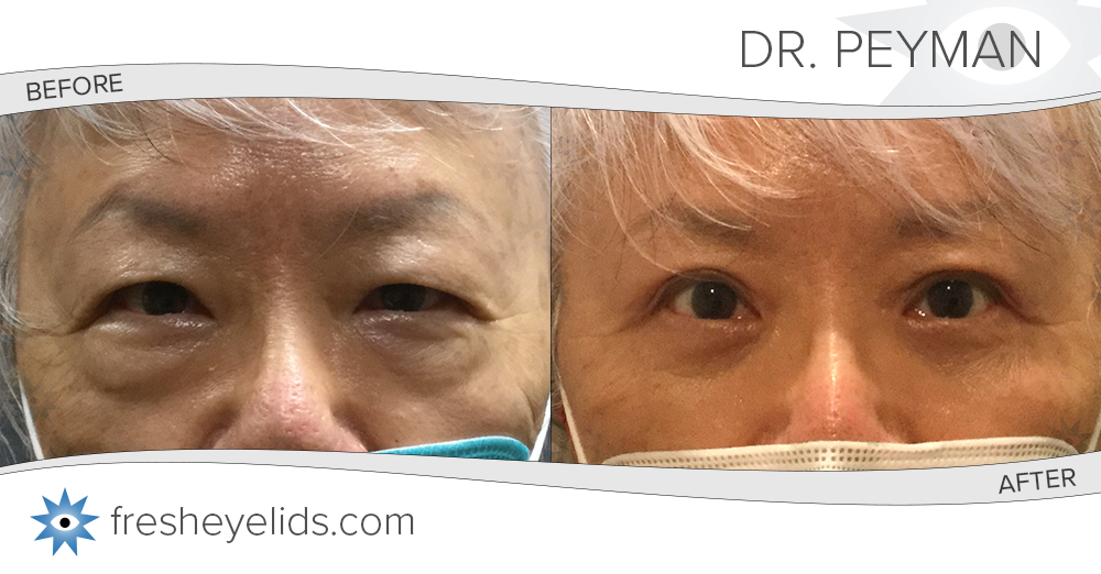 Total Eye Rejuvenation: Look Refreshed with Combined Upper & Lower ...