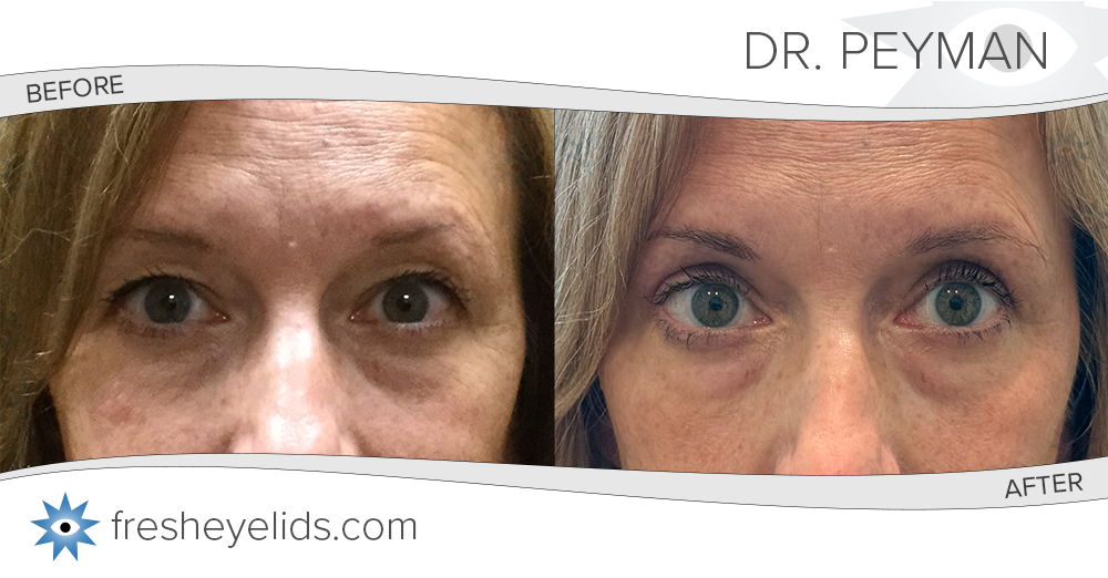 Upper Blepharoplasty: Reveal Your Eyes' Natural Radiance | Eyelid ...