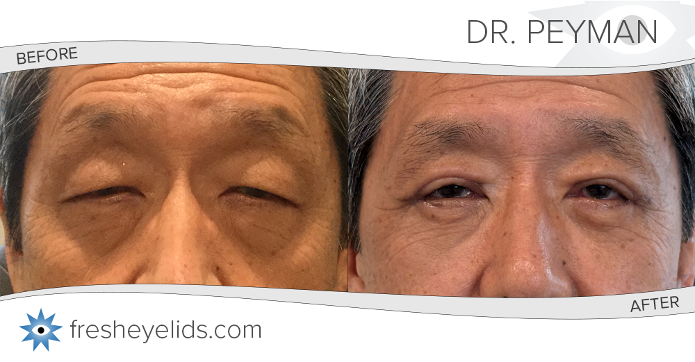 Natural Results: A Guide to Asian Eyelid Surgery in Orange County ...