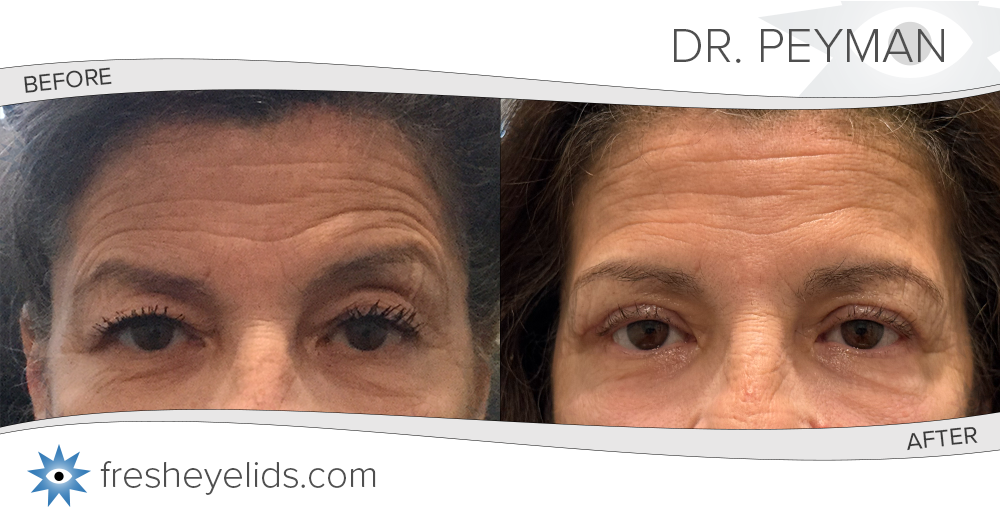 Beyond the Lift: Restoring Brow Symmetry with Blepharoplasty and Botox ...