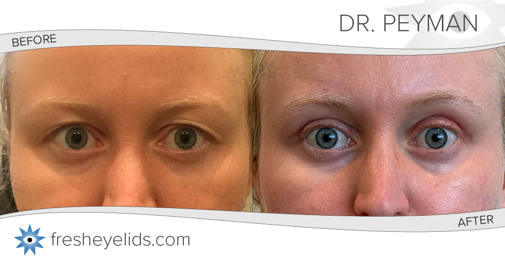 Reveal Your Eyes: How Blepharoplasty Unveils the Eyelid Platform ...