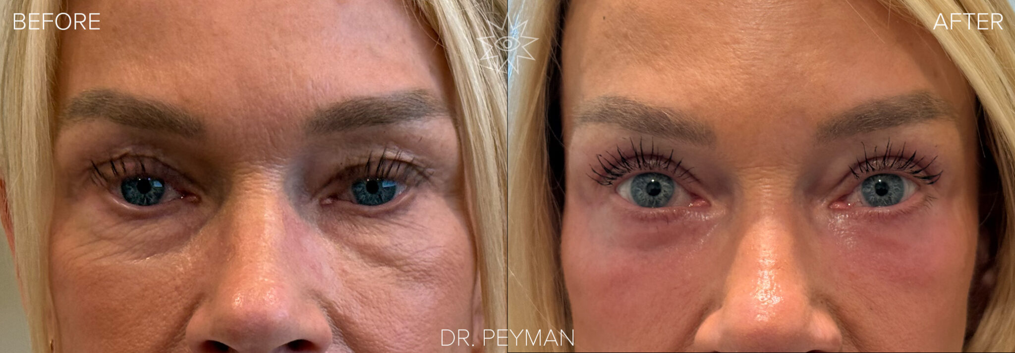 Bring Back the Gleam: The Art of Total Eye Rejuvenation | Eyelid ...