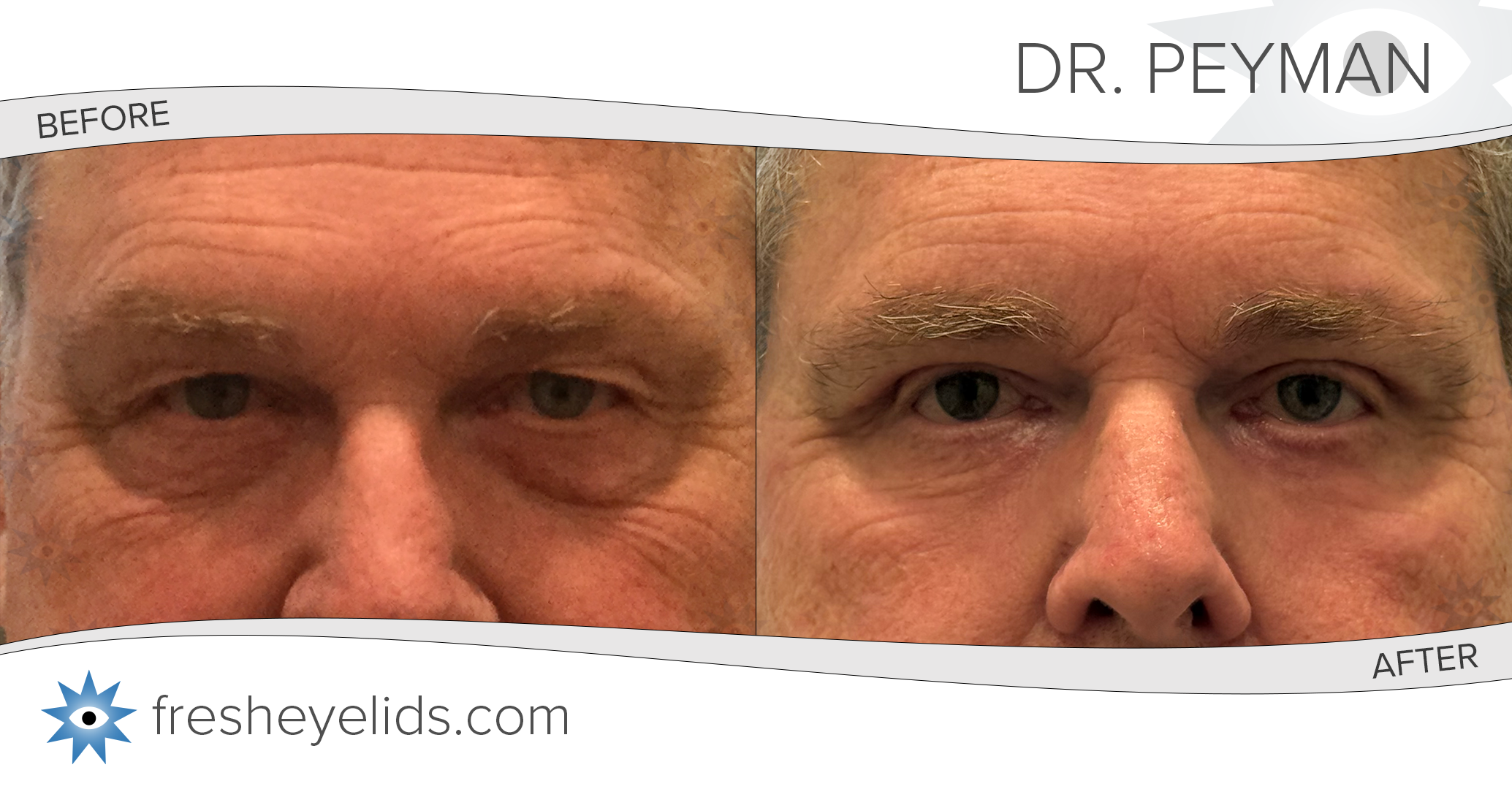More Than Rested: Restoring a Healthy, Vibrant Look with Eyelid Surgery ...