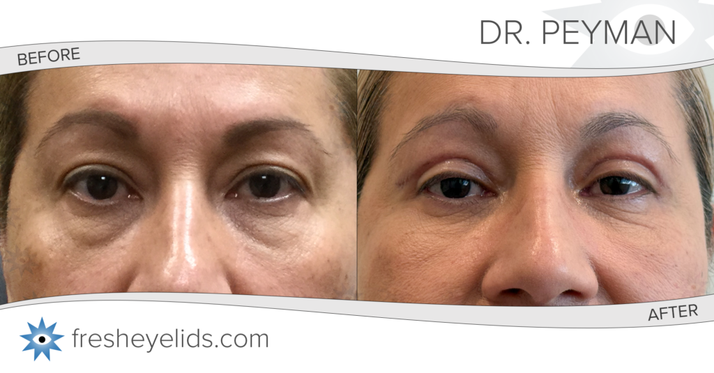 The Hidden Feature That Defines Youthful Eyes: Unveiling the "Eyelid ...